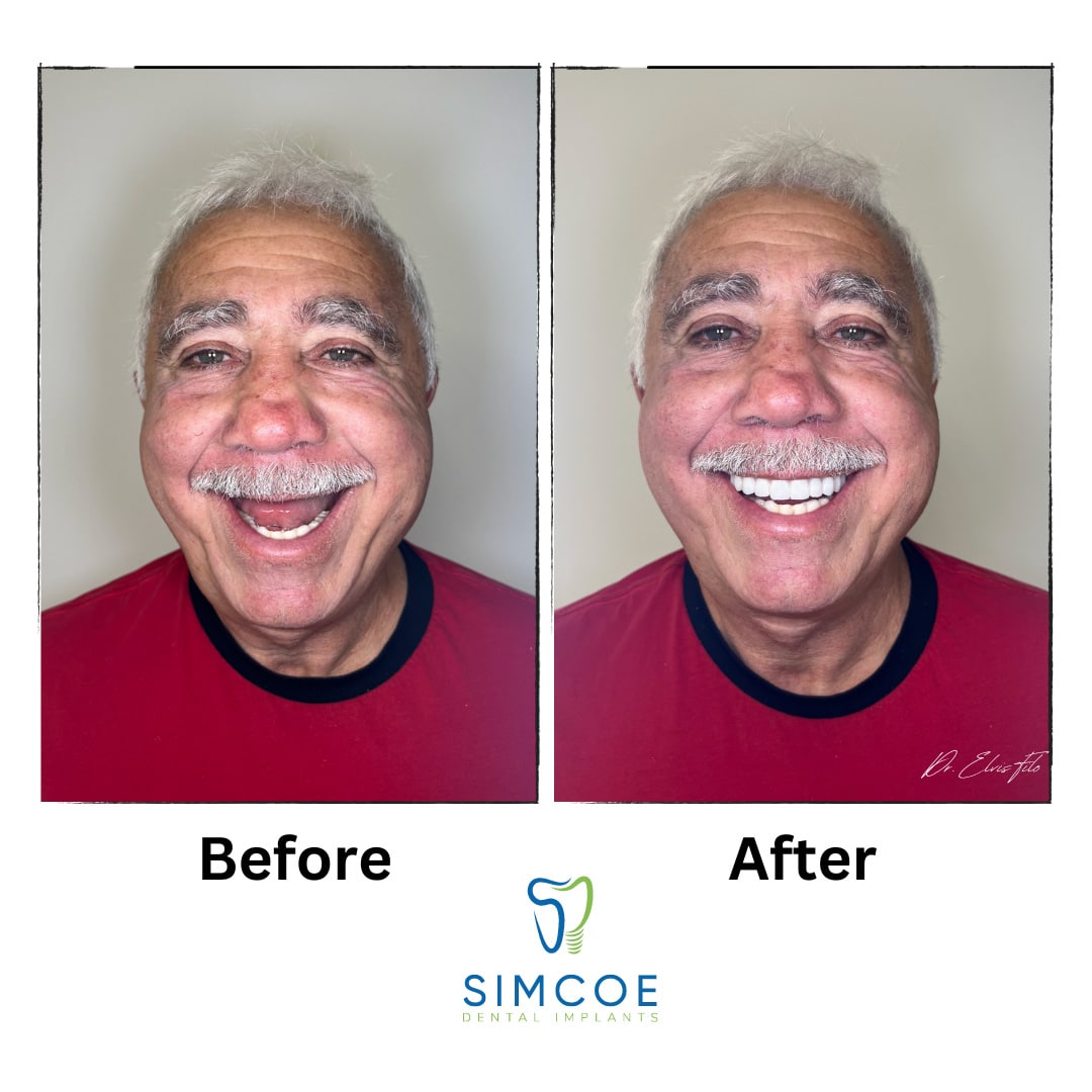 Smile Gallery - Simcoe Dental Implants